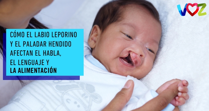 Cómo el labio leporino y el paladar hendido afectan el habla, el ...